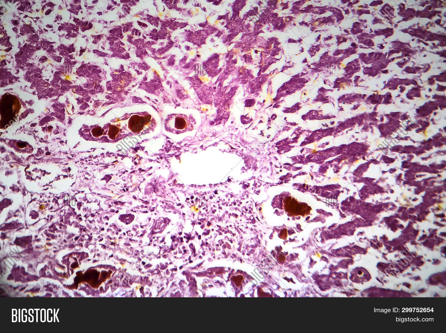 Histopathology Of Acute Severe Hepatitis, Light Micrograph, Photo Under ...